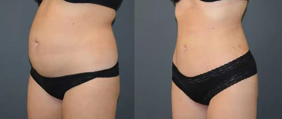 Liposuction Nashville: What to Expect Before & After - Nashville Liposuction Specialty Clinic